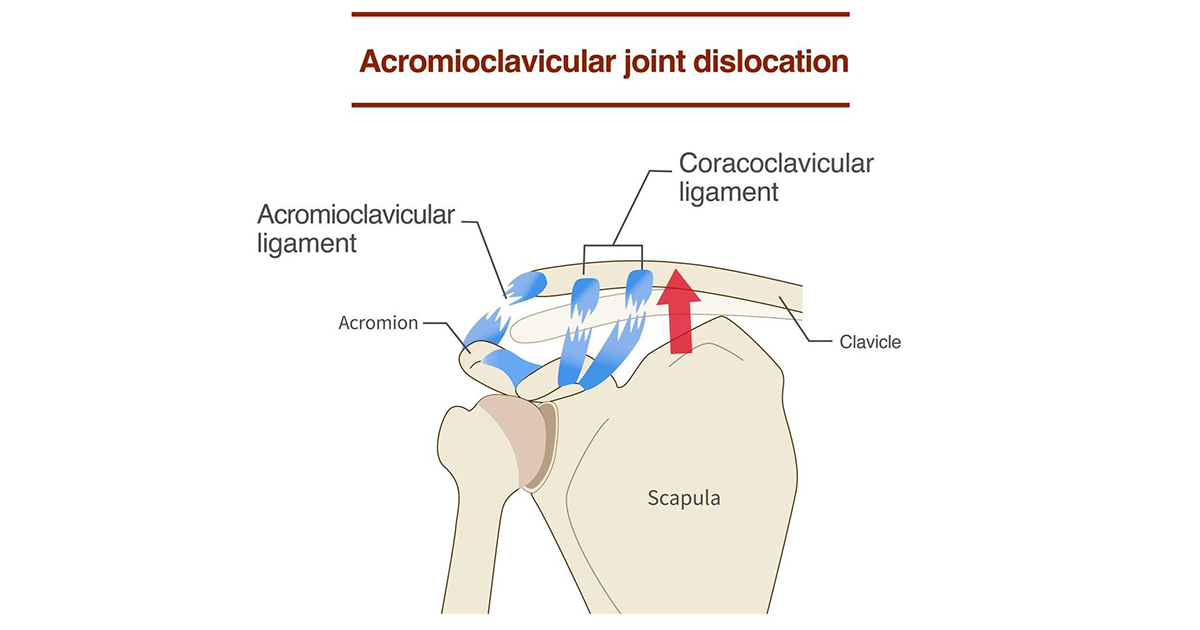 Understanding AC Joint Dislocations